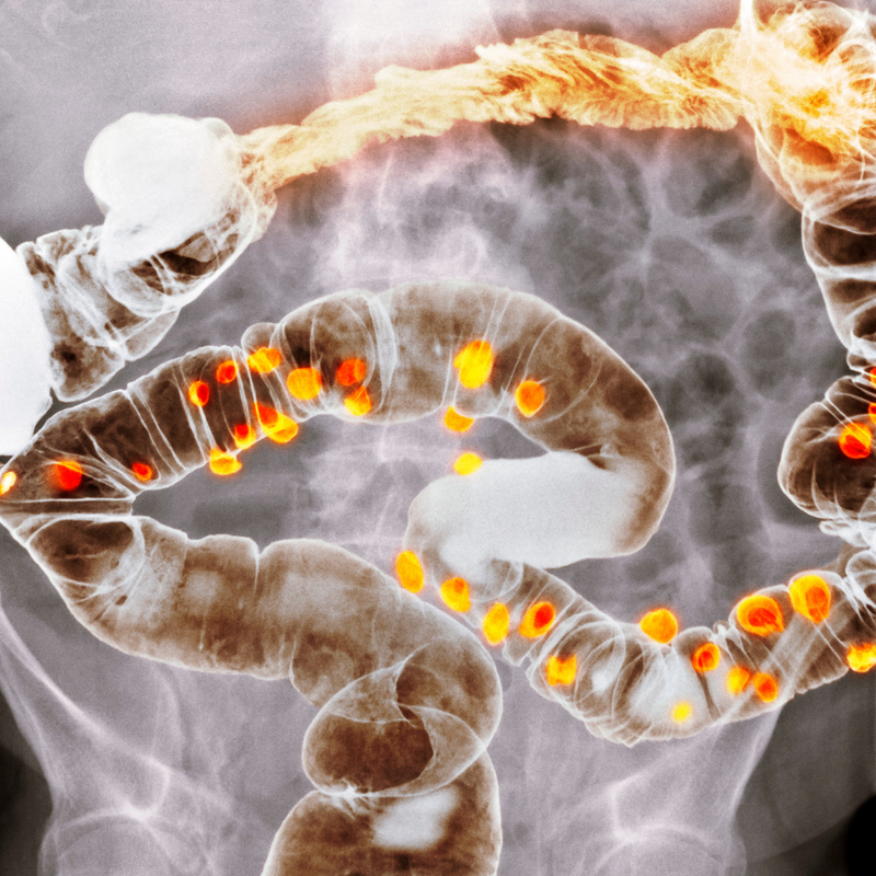 Probiotics And Diverticulitis Immunity Fuel Limited